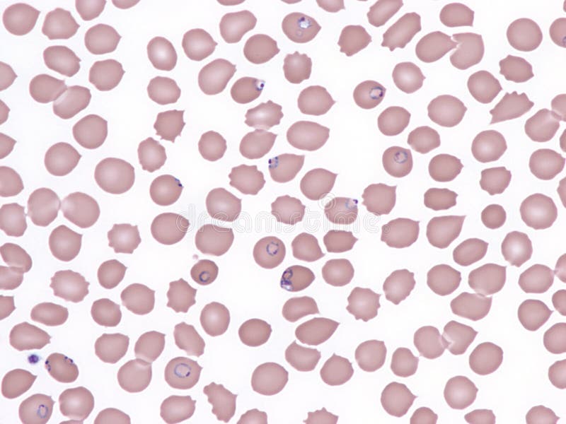 Malaria.Ring Forms of Plasmodium Falciparum in Peripheral Blood. Stock ...