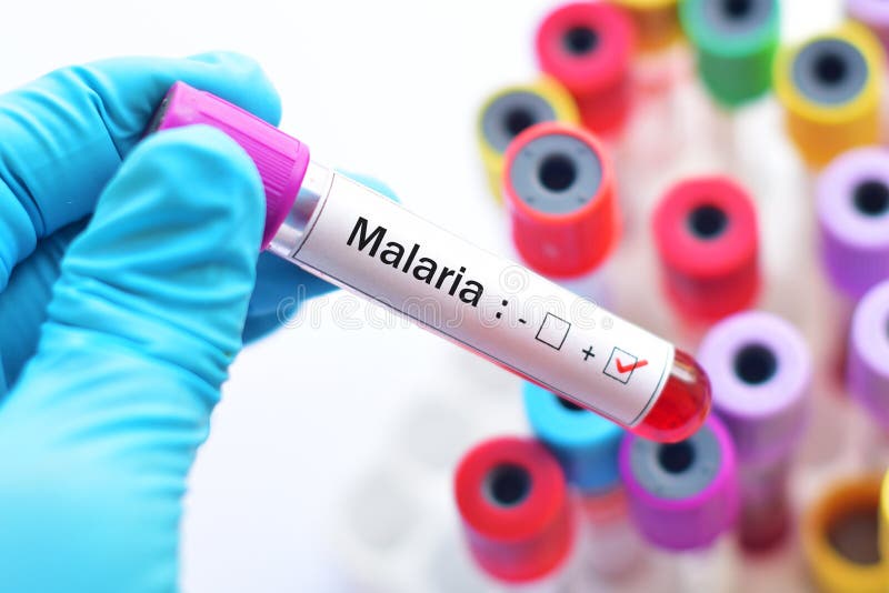 Malaria Positive Test Result Stock Image - Image of malariae, blood ...