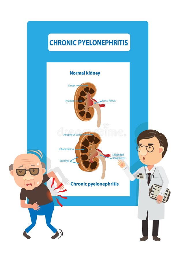 Malattia renale cronica illustrazione vettoriale. Illustrazione di ...
