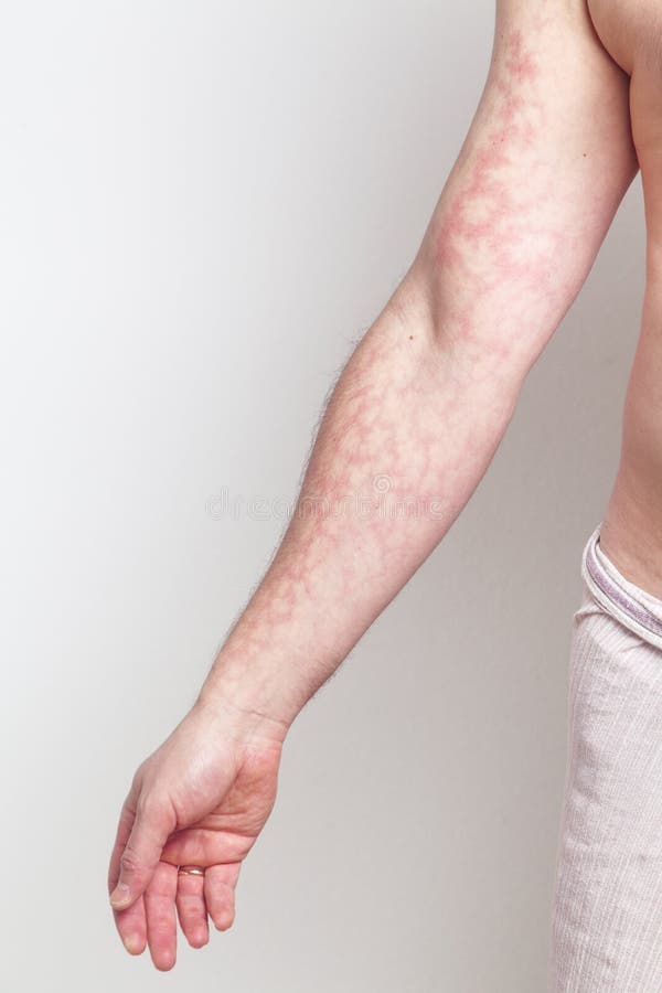 Male Arm with Red Skin Capillary Network Stock Photo - Image of ...