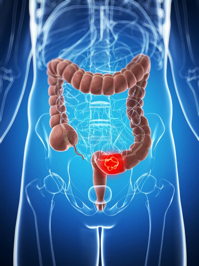 Male colon - cancer stock illustration. Illustration of rectum - 28961630