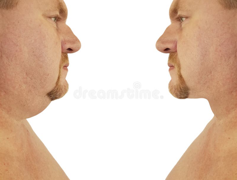 Male Double Chin Correction before and after Procedures Stock Photo ...