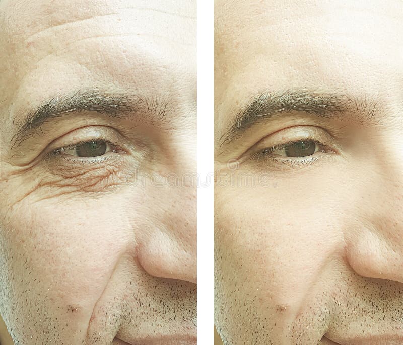 Male Face Wrinkles Removal Forehead before and after Treatment Effect ...