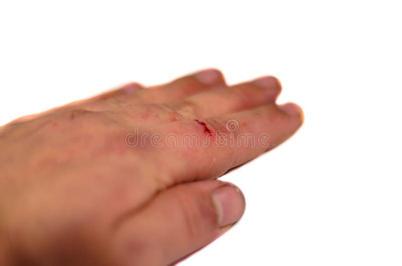 Bleeding thumb finger stock photo. Image of finger, sore - 15006988