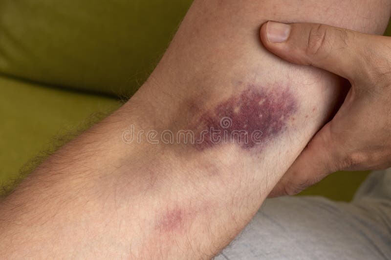 Male Hand with a Large Hematoma. Stock Image - Image of skin, hand ...