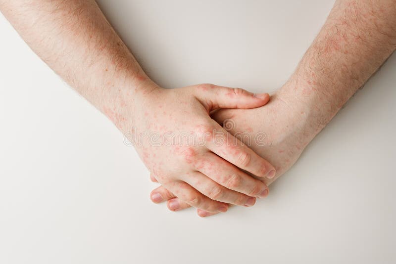 Hands with Allergy Reaction from Taking Medicines. by-effect ...