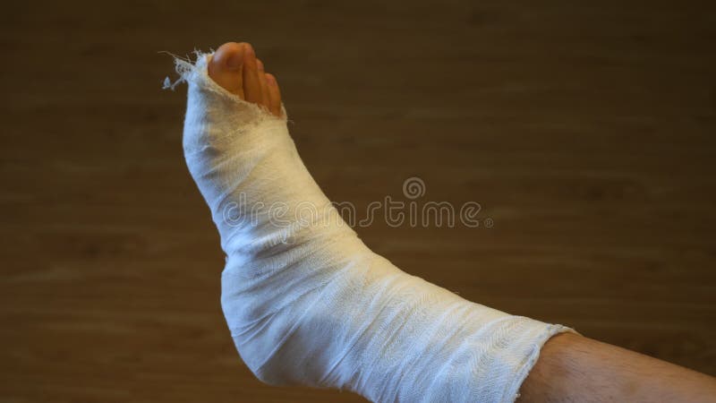 Male Leg in a Plaster Cast. Toes Moving. Against the Background of the ...