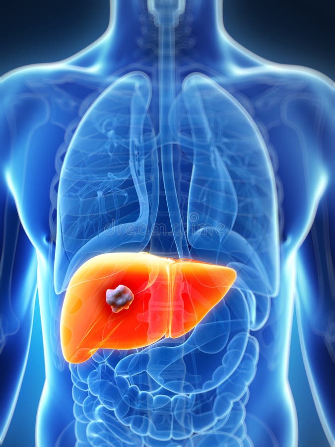 Liver cancer stock illustration. Illustration of graphic - 13325167