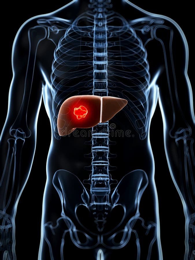 Stomach Cancer Metastasized To the Liver Stock Vector - Illustration of ...