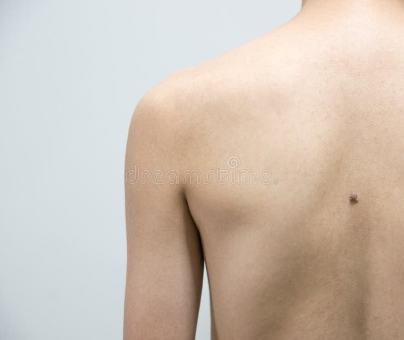 124 Back Warts Stock Photos - Free & Royalty-Free Stock Photos from ...