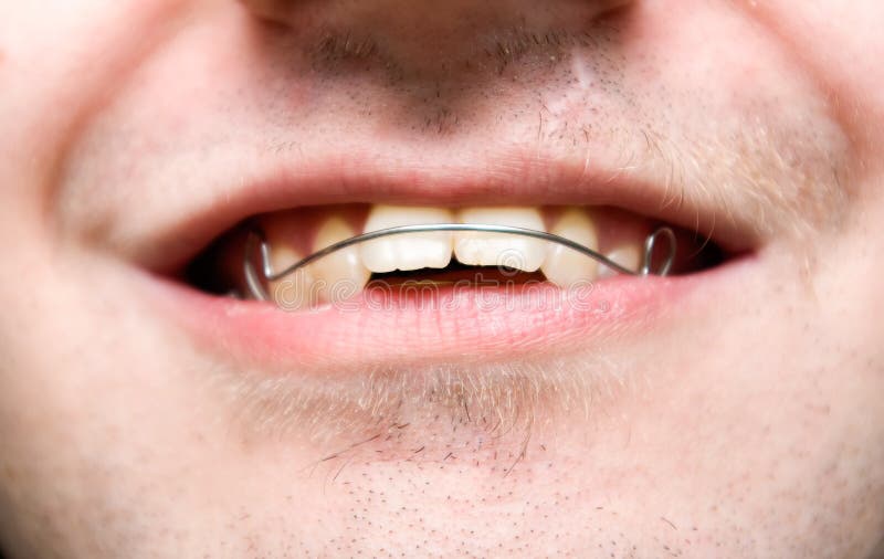 Male with Overbite Wearing Braces and Smiling Stock Image - Image of ...