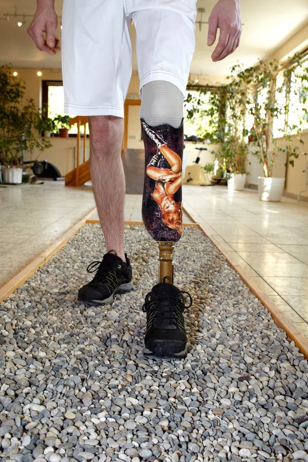 Male Prosthesis Wearer Learning To Walk Stock Image - Image of ...