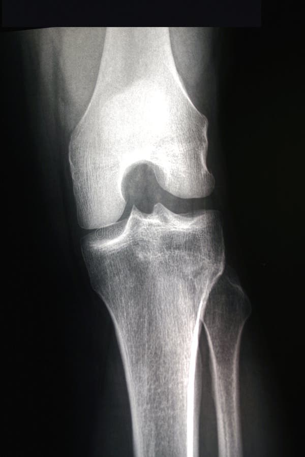 Male Right Knee - Bent stock photo. Image of disease, clinic - 1423572