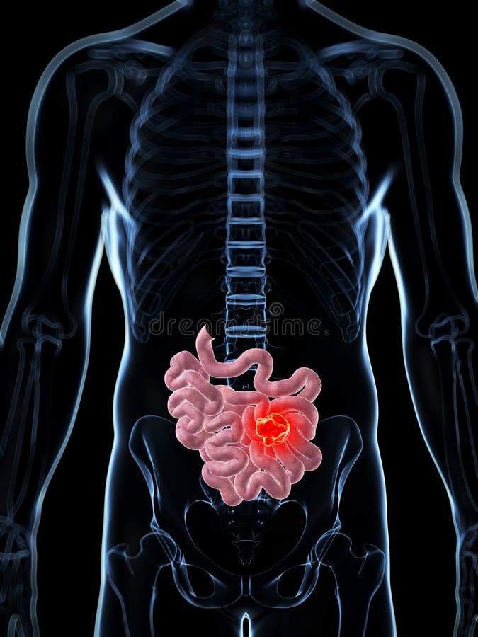 Male Small Intestine - Cancer Stock Illustration - Illustration of ...