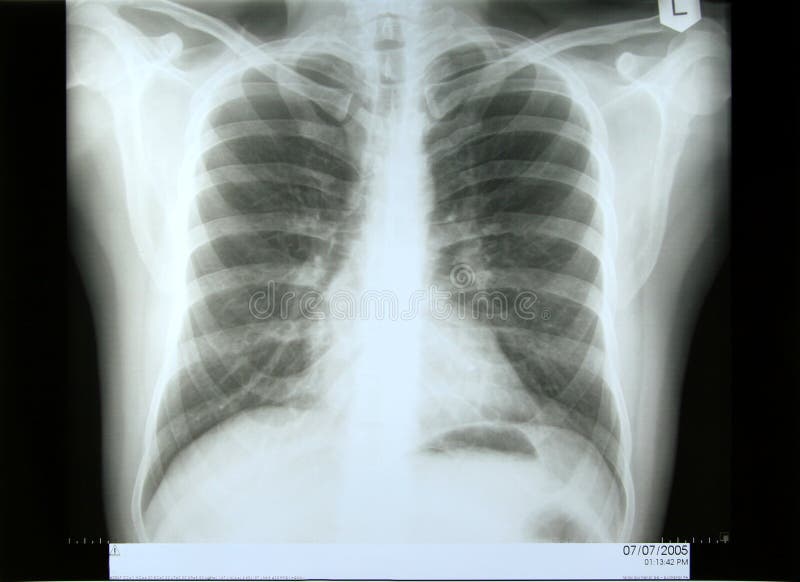 Male torax xray stock image. Image of technology, examination - 1668917