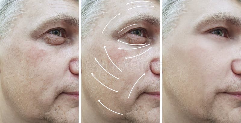 Male Wrinkles Correction before and after Difference Procedures, Arrow ...