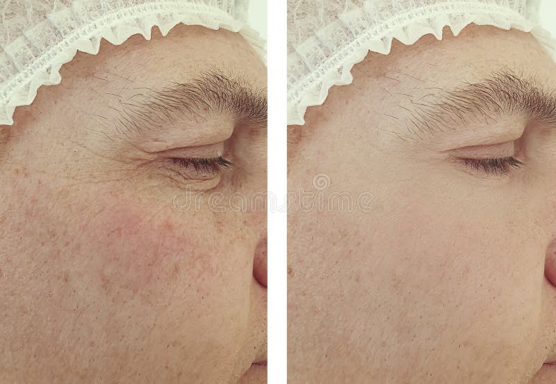 Male Forehead Wrinkles before and after Biorevitalization Cosmetology ...