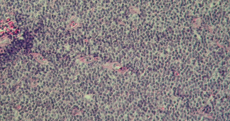 Malignant lymphoma tissue stock footage. Video of digestion - 205829770