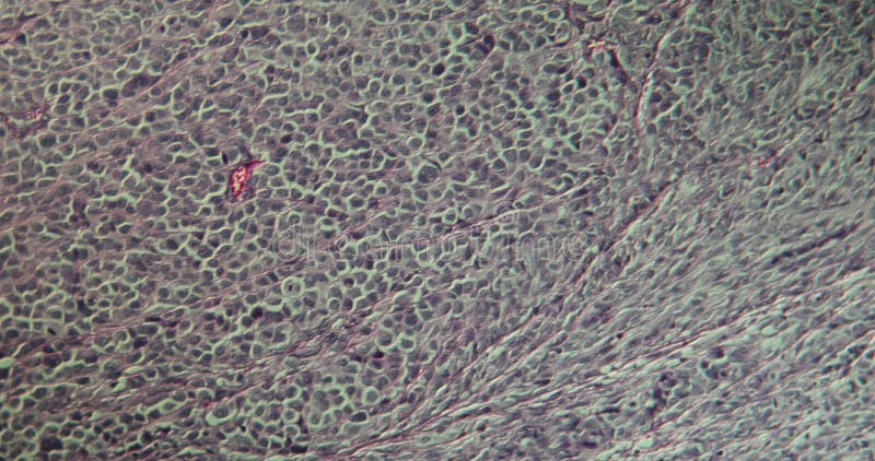 Malignant Melanoma Tumor Disease Stock Footage - Video of diagnose ...