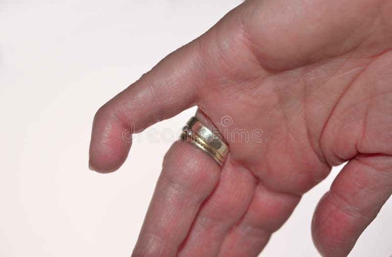 A mallet finger stock image. Image of medicine, anatomy - 85170245
