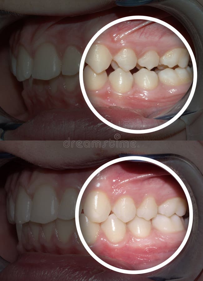 Malocclusion after and before Orthodontic Treatment Stock Photo - Image ...