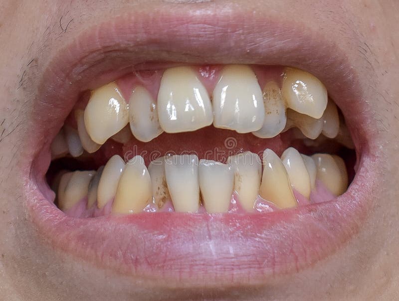 Malocclusion, Overcrowding of Both Upper and Lower Teeth Stock Image ...