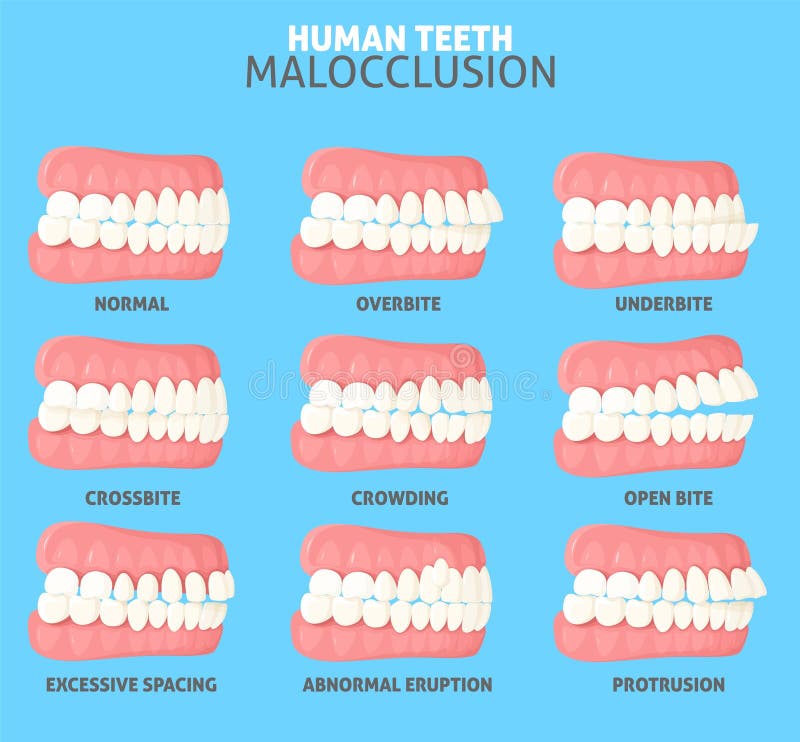 Malocclusion Types Side View Dentist Medical Poster Stock Vector ...