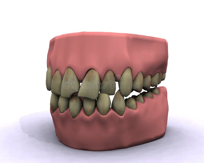 Dientes Feos, Boca Abierta Y Síntomas De La Enfermedad De Las Encías ...