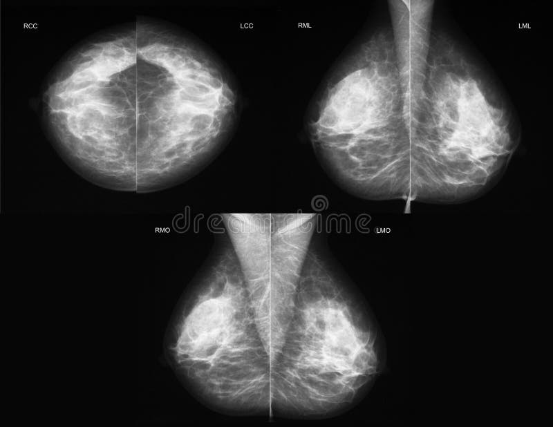 Mammographie in Allen Projektionen Stockfoto - Bild von bild ...