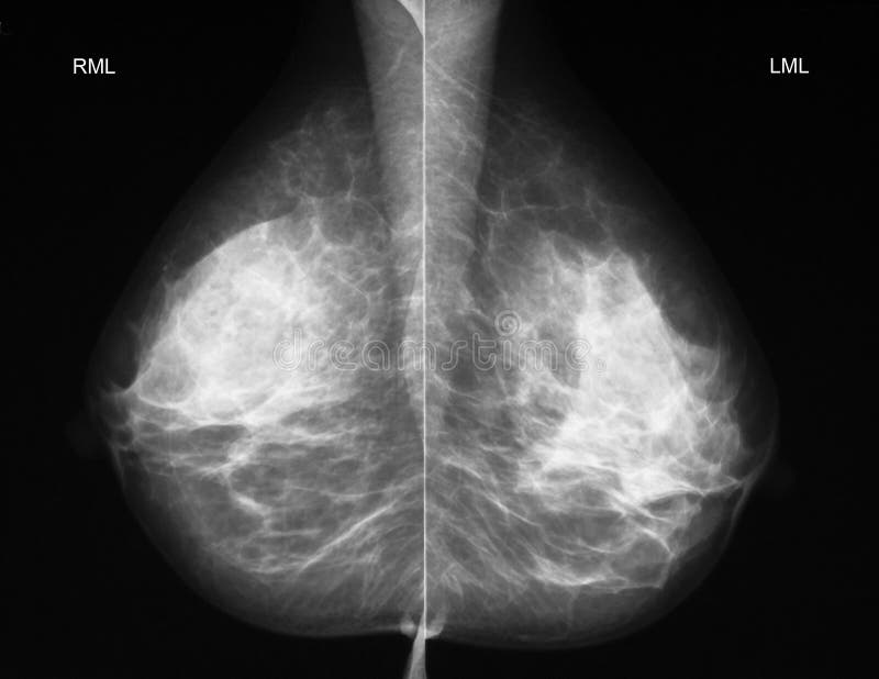 Mammography In Mediolateral Projection Stock Photo - Image: 10049710