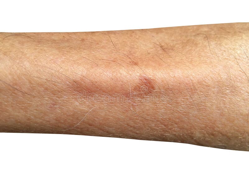 Arm Skin Freckles in the Elderly, Selective Focus Stock Image - Image ...