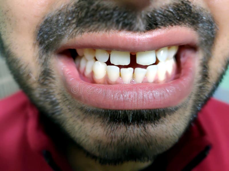 A Man with a Beard Shows His Teeth, he Has a Tooth Gap Stock Photo ...