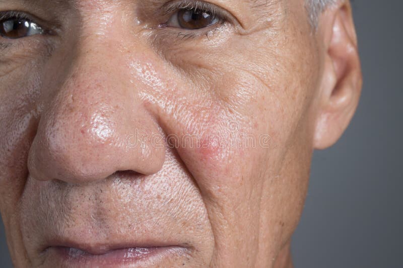 Man with a Big Ugly Pimple on His Cheek Stock Image - Image of tooth ...