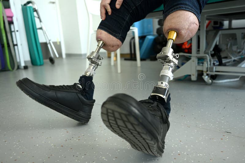 A Man with Bone-implanted Leg Prostheses. Osteointegration Stock Photo ...