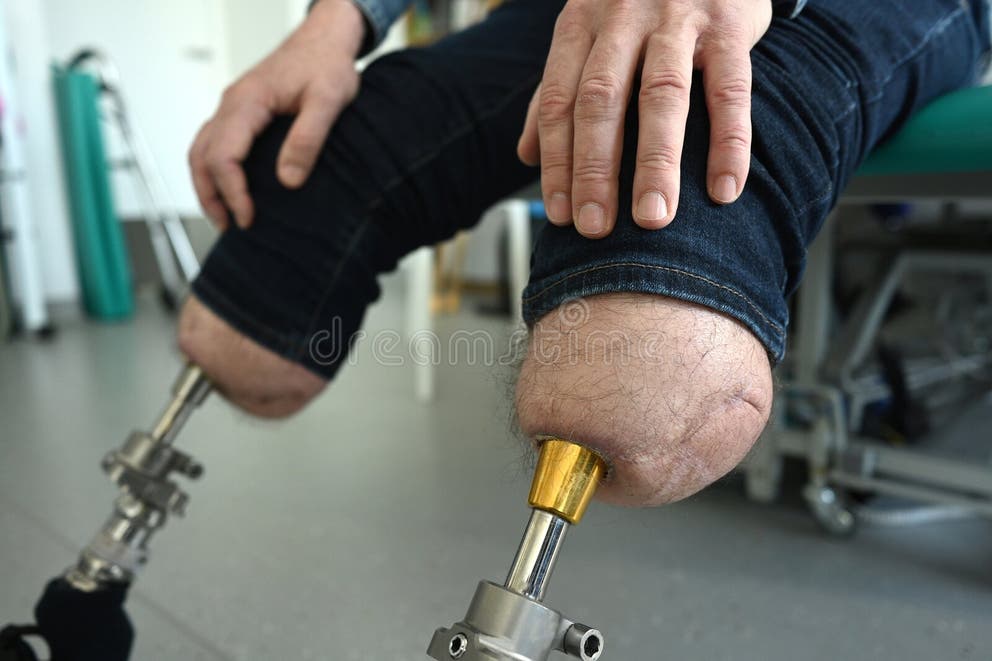 A Man with Bone-implanted Leg Prostheses. Osteointegration Stock Image ...