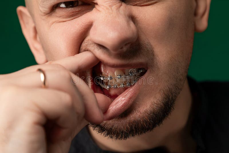 Man with Braces Making Silly Face Stock Photo - Image of treatment ...