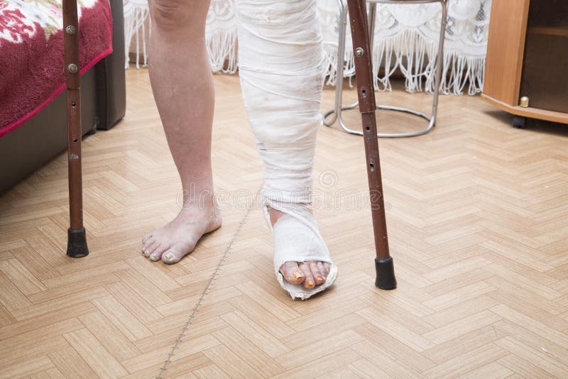A Man with a Broken Leg.a Cast on a Man`s Leg Stock Image - Image of ...