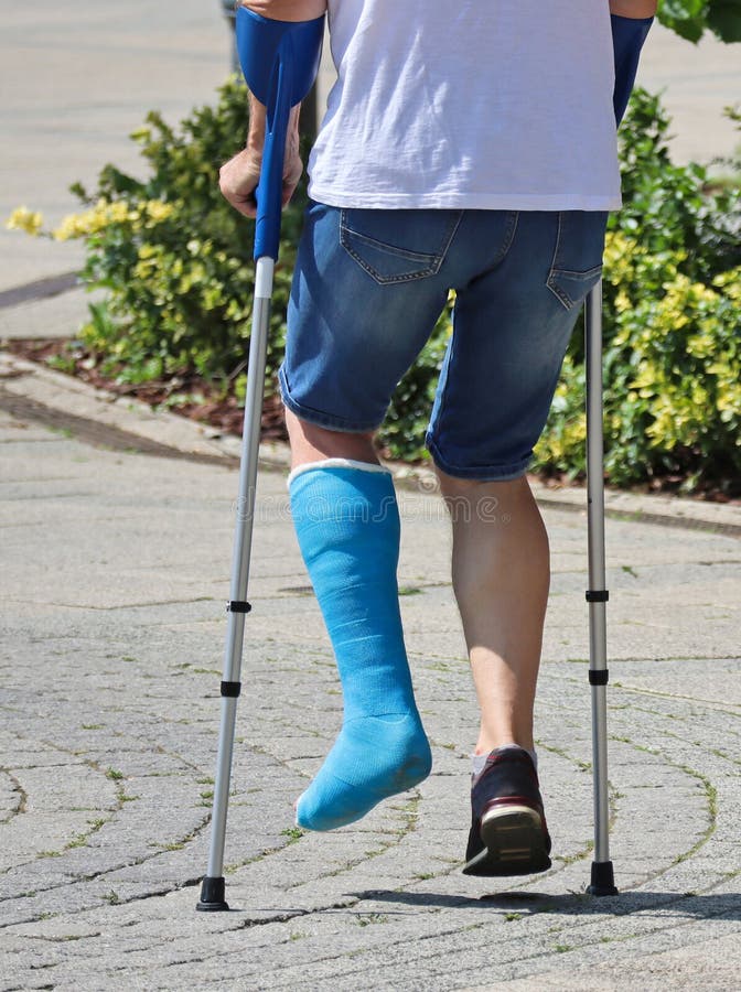Man with Broken Leg Walks on the Street Stock Photo - Image of summer ...