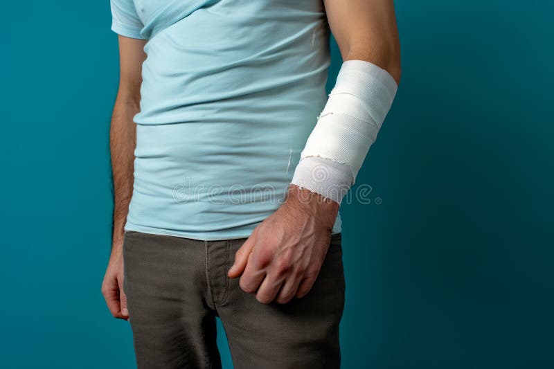 Man with Cast on His Arm and Cast on His Arm. Generative AI Stock Image ...