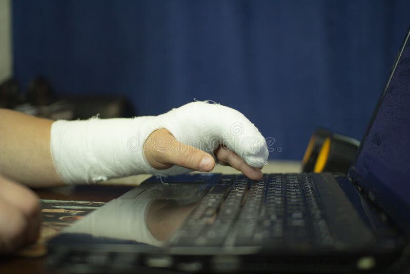 A Man with a Cast on His Arm is Working at a Computer Stock Image ...