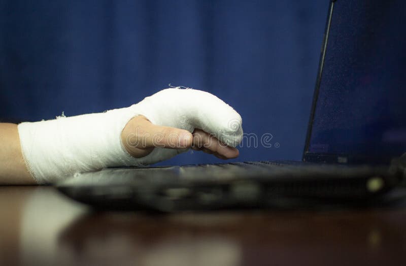 A Man with a Cast on His Arm is Working at a Computer Stock Photo ...