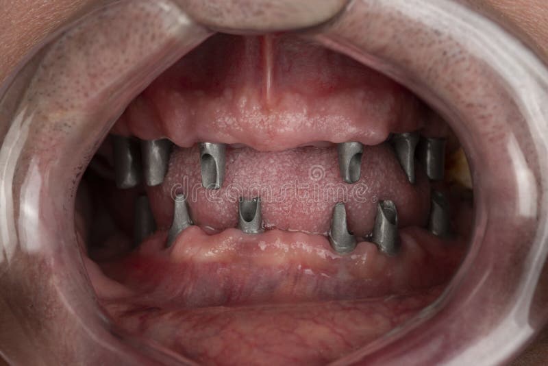 Man Cavity Protected by Retractor Showing Perfect Teeth.implants and ...