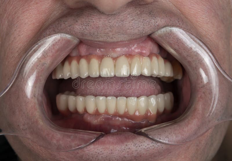 Man Cavity Protected by Retractor Showing Perfect Teeth.implants and ...