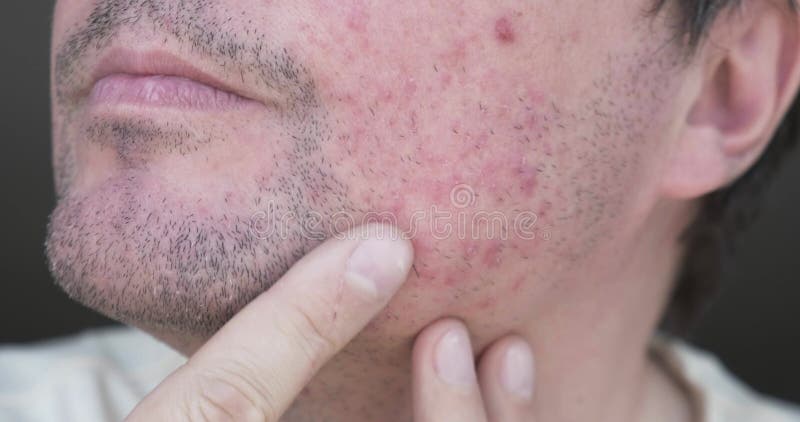 Man Checks Dermatitis on His Face. Eczema Close Up Stock Footage ...