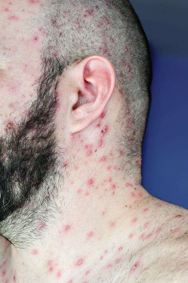 Man with chickenpox stock photo. Image of clinic, health - 134326154