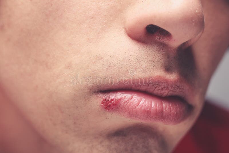 Cold sores stock photo. Image of lips, person, disgusting - 20934192