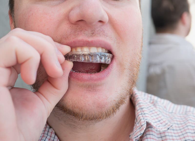 A Man Demonstrates Putting on a Plastic Aligner Plate from Brcusism, a ...