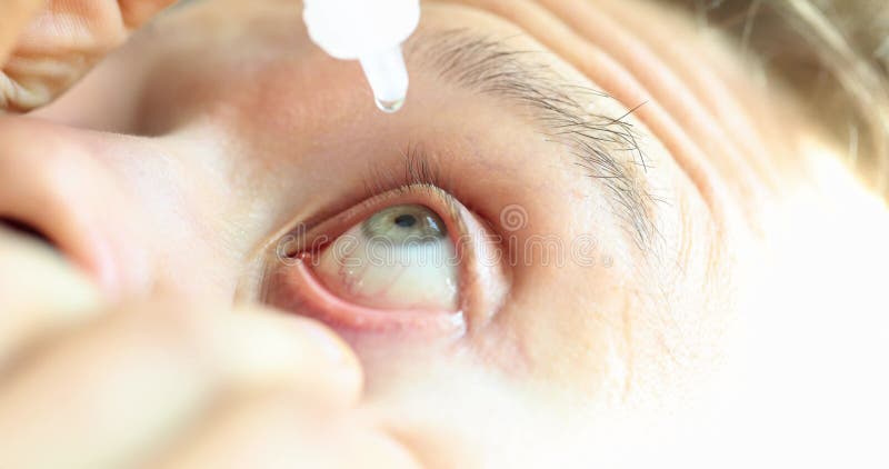 Man Dripping Liquid Drops into Dry Eyes Stock Video - Video of solving ...