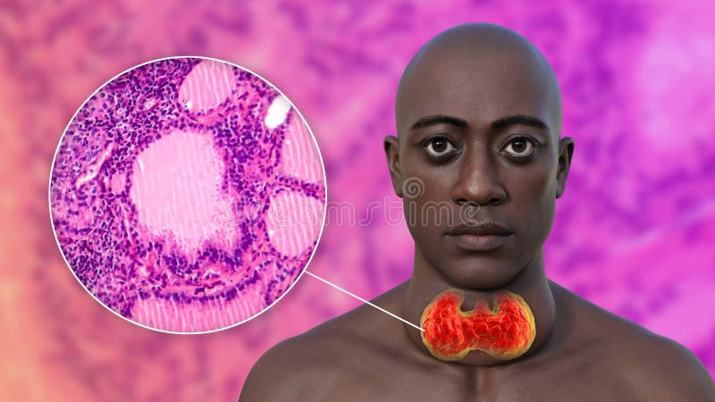 A Man with Enlarged Thyroid Gland, 3D Illustration, and Micrograph ...