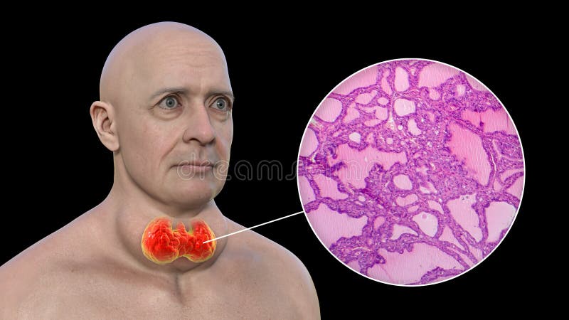 A Man with Enlarged Thyroid Gland, 3D Illustration, and Micrograph ...